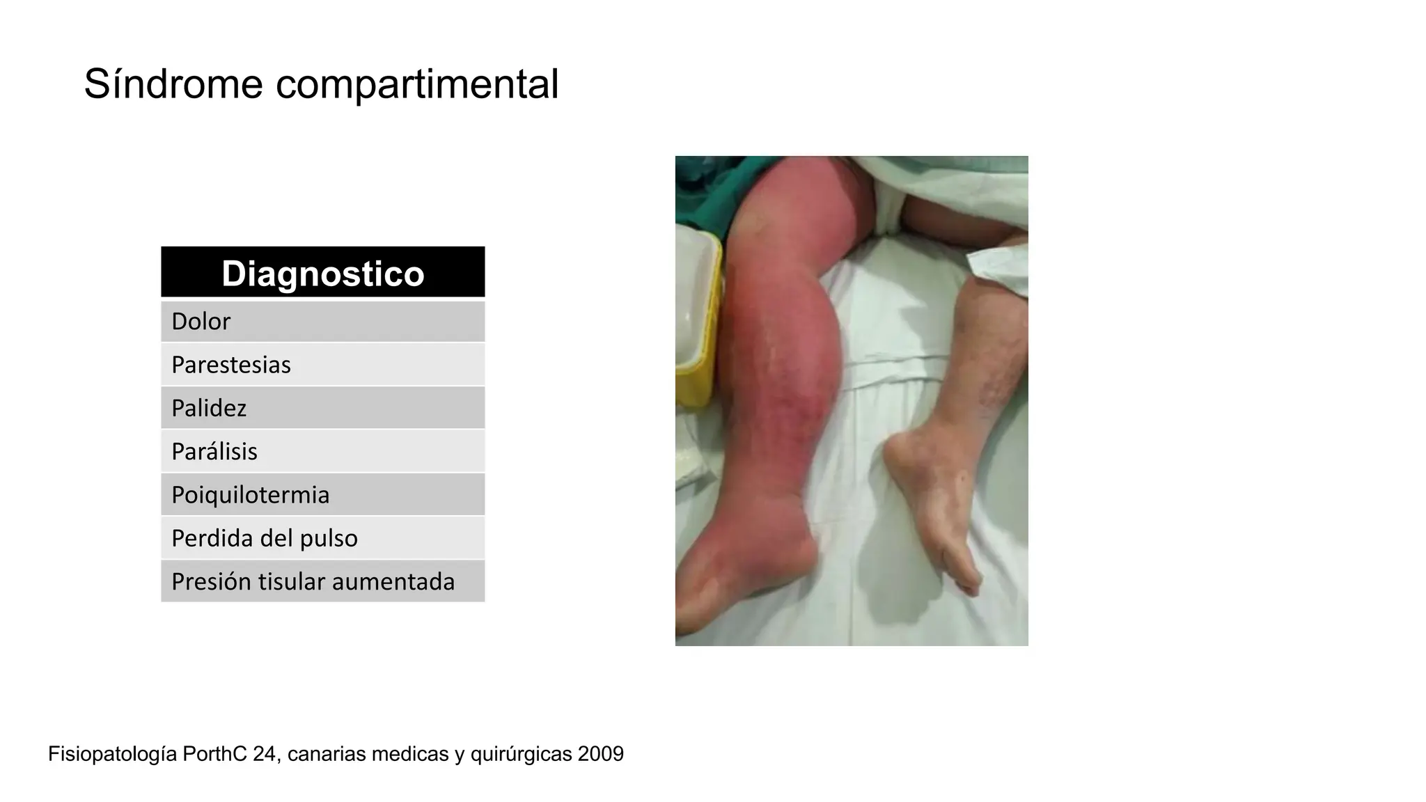 sindrome compartimental draMARIAFERNARNADA | PPT
