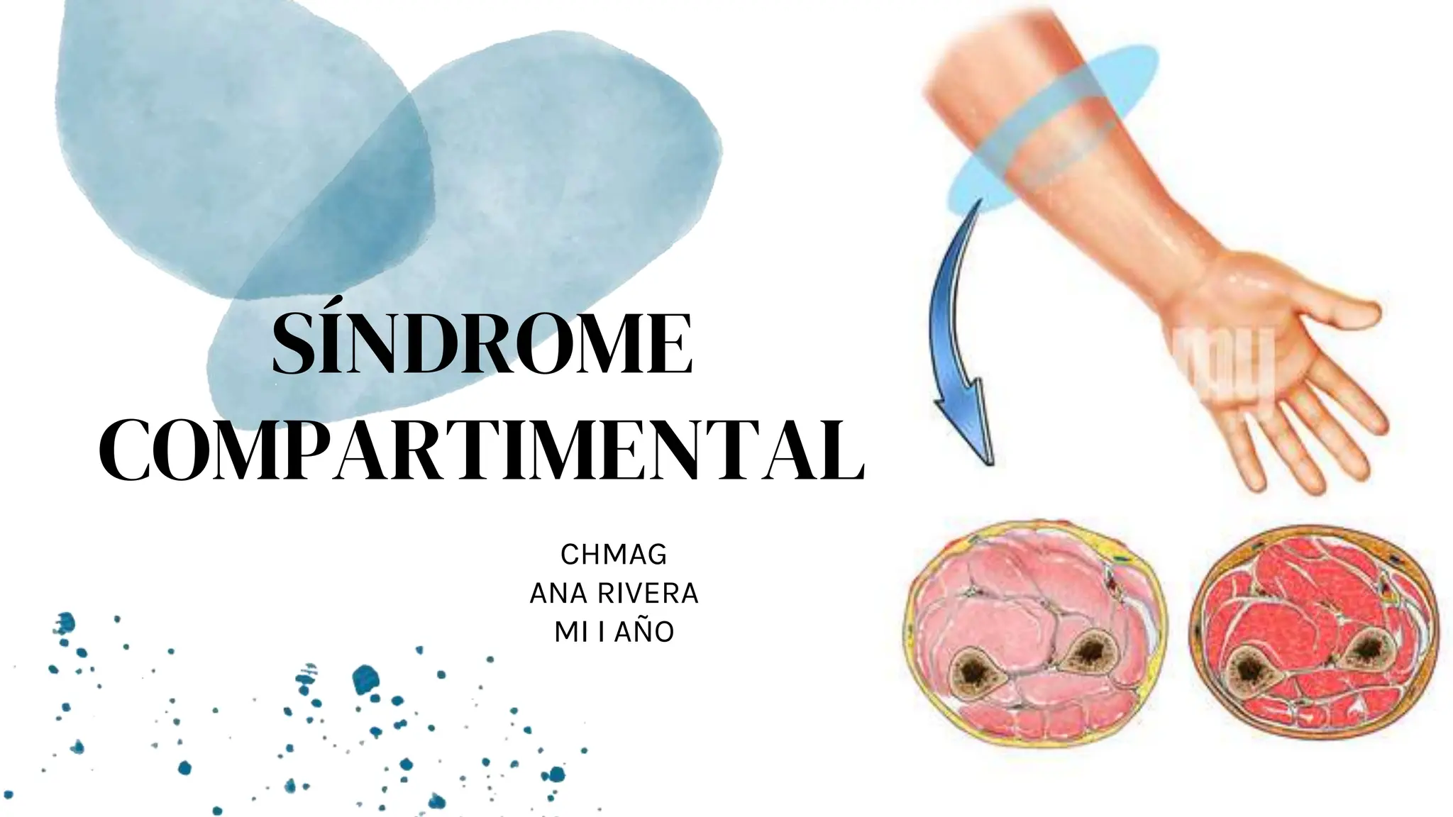 diapositivas de Sindrome compartimental.pptx