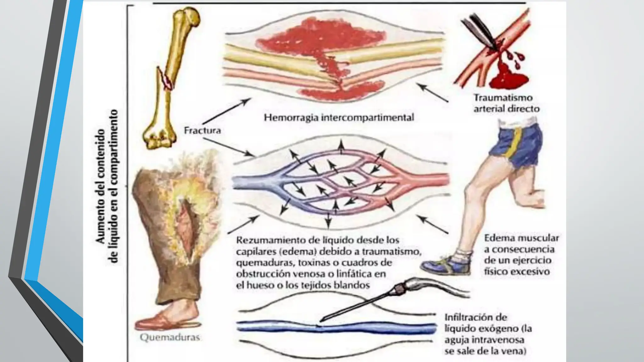 Sindrome_Compartimental concepto y tipos | PDF