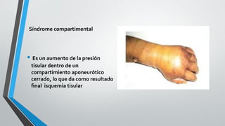 Sindrome_Compartimental concepto y tipos | PPT
