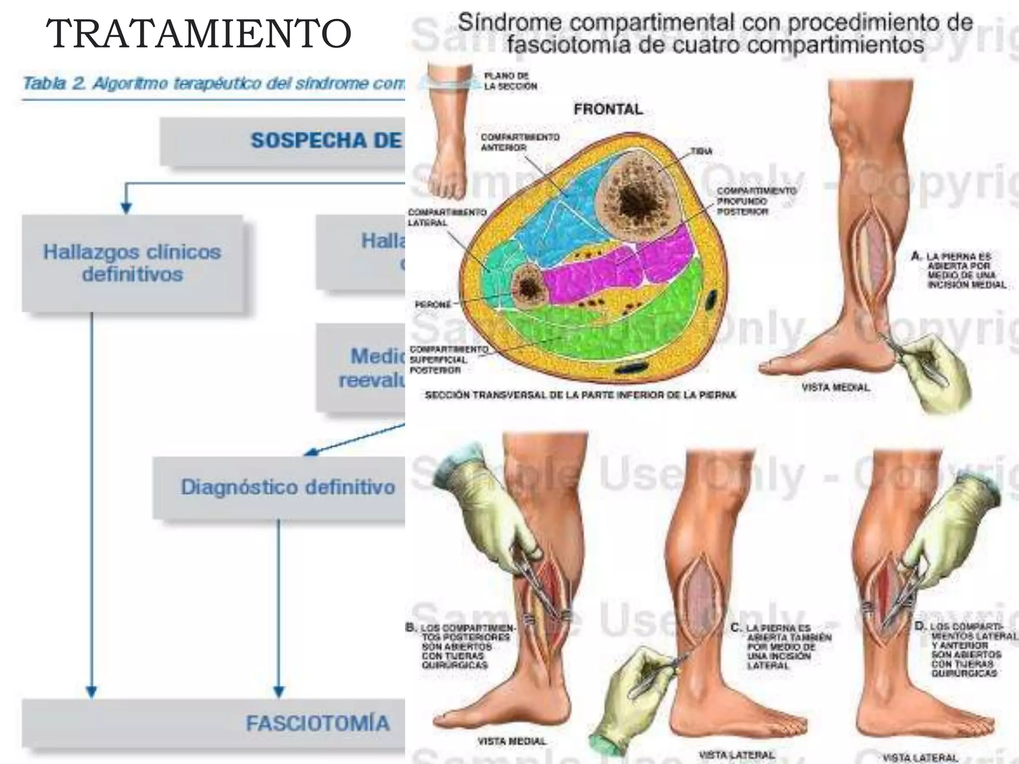 Sindrome compartimental agudo | PPTX