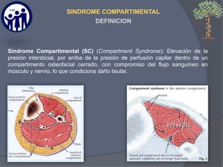 Sindrome compartimental | PPTX