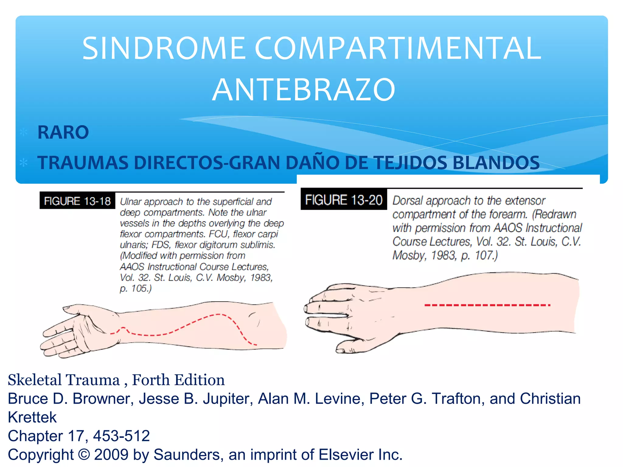 SINDROME COMPARTIMENTAL ASPECTOS DIAGNOSTICOS Y DE TRATAMIENTO | PPT