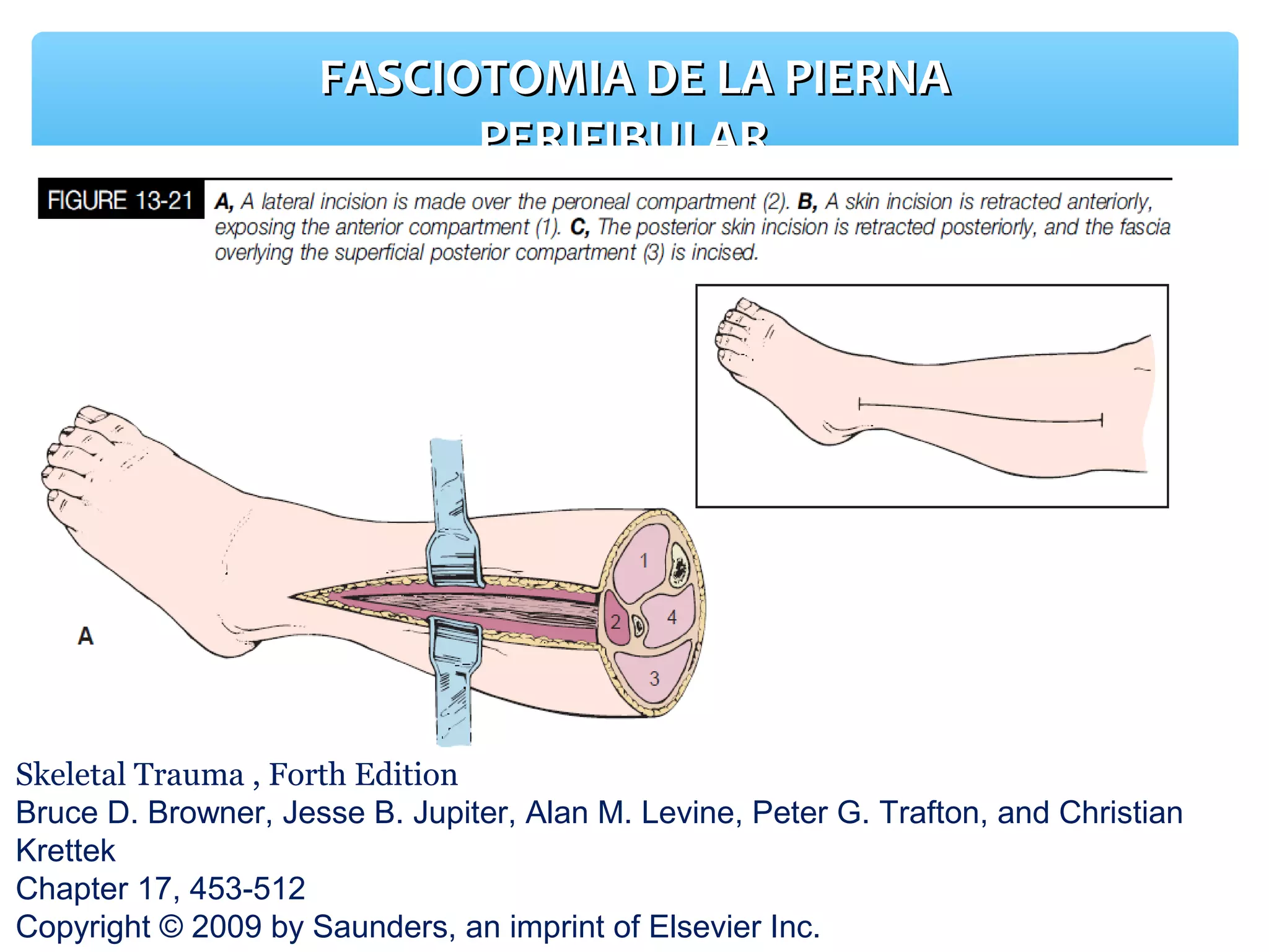 SINDROME COMPARTIMENTAL ASPECTOS DIAGNOSTICOS Y DE TRATAMIENTO | PPT