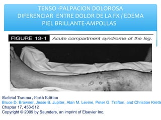 SINDROME COMPARTIMENTAL ASPECTOS DIAGNOSTICOS Y DE TRATAMIENTO | PPT