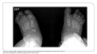 Sindrome de Conradi y Sindrome de WHIM.pptx