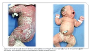 Sindrome de Conradi y Sindrome de WHIM.pptx