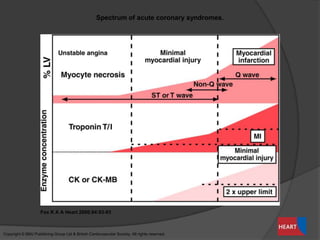 Sindrome coronario agudo | PPTX
