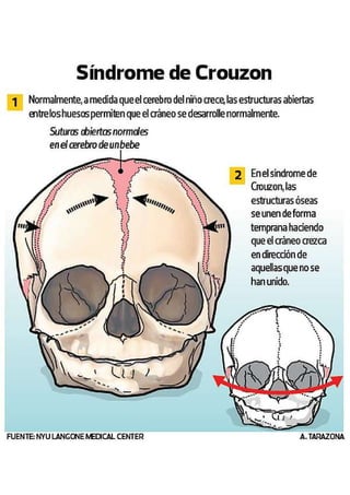 SINDROME CROUZON.pdf