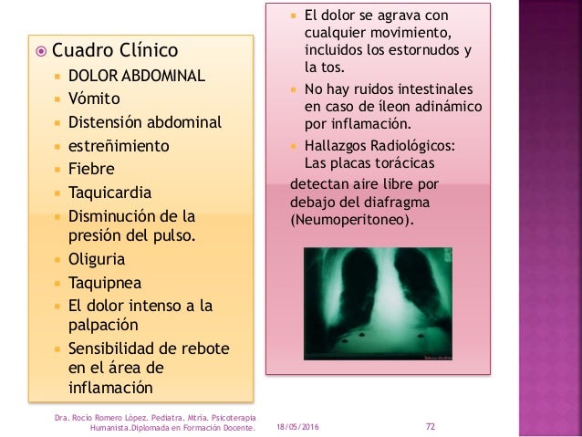 Sindrome de abdomen agudo