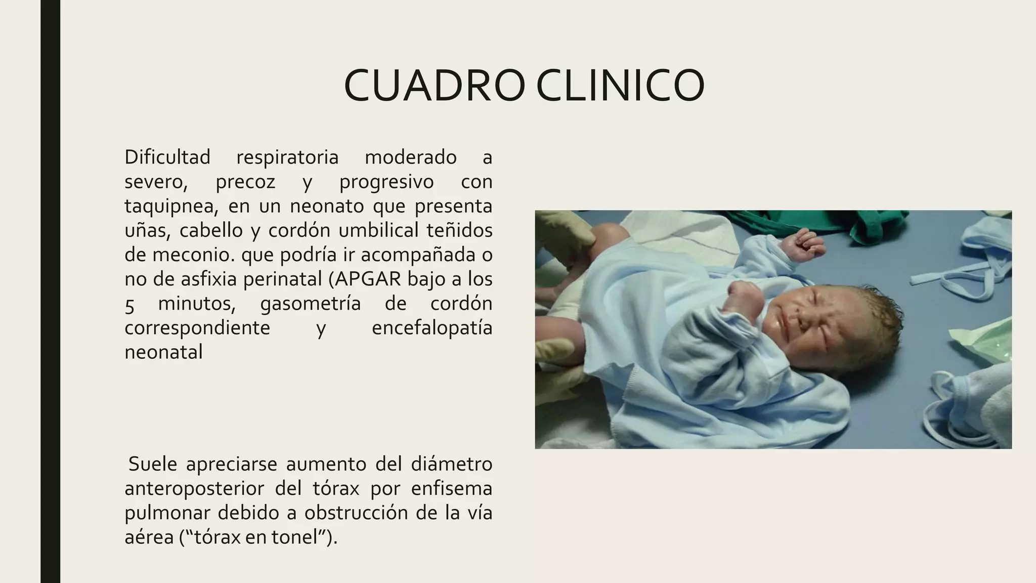 Sindrome de aspiracion de meconio | PPT