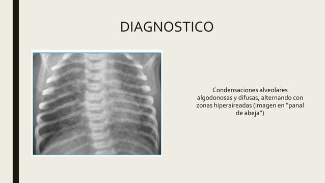 Sindrome de aspiracion de meconio | PPT