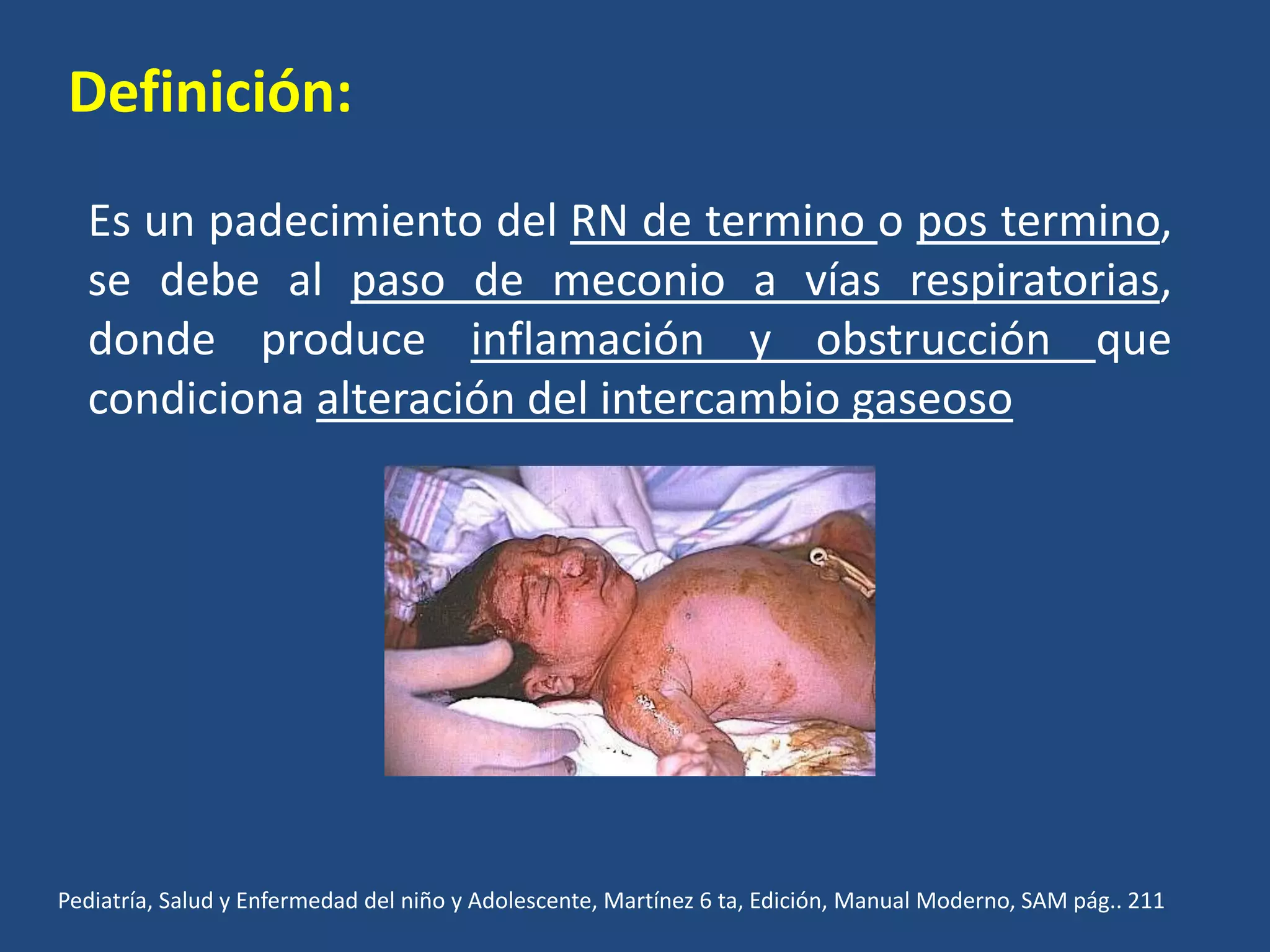 Sindrome de aspiracion meconial | PPT