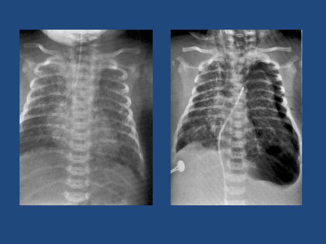Sindrome de aspiracion meconial | PPTX