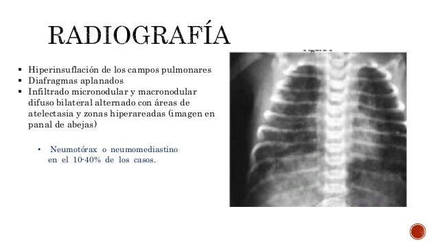 Sindrome de aspiracion meconial