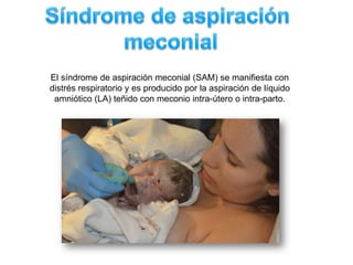 Sindrome de aspiracion meconial | PDF