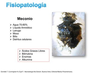 Sindrome de aspiracion meconial | PDF
