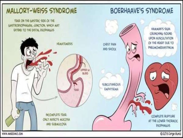 Sindrome de Boerhaave - Maria Pasquel