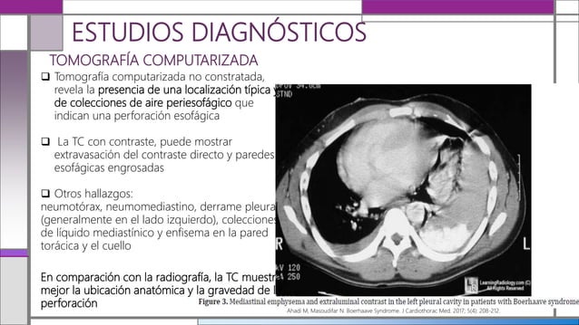 Síndrome de Boerhaave/ Perforación esofágica espontánea | PPT