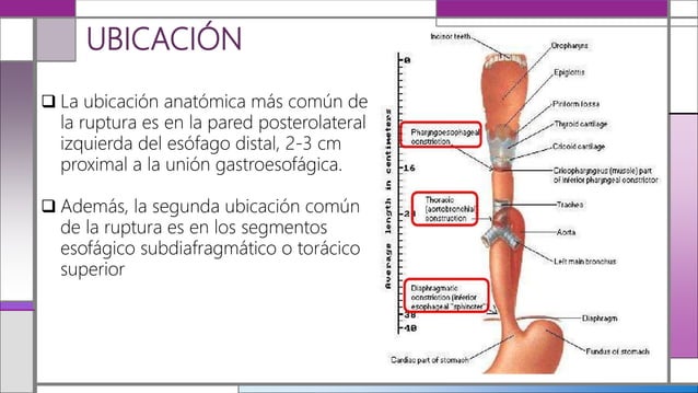 Síndrome de Boerhaave/ Perforación esofágica espontánea | PPT