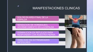 SINDROME DE COMPRESIÓN RADICULAR LUMBAR.pptx