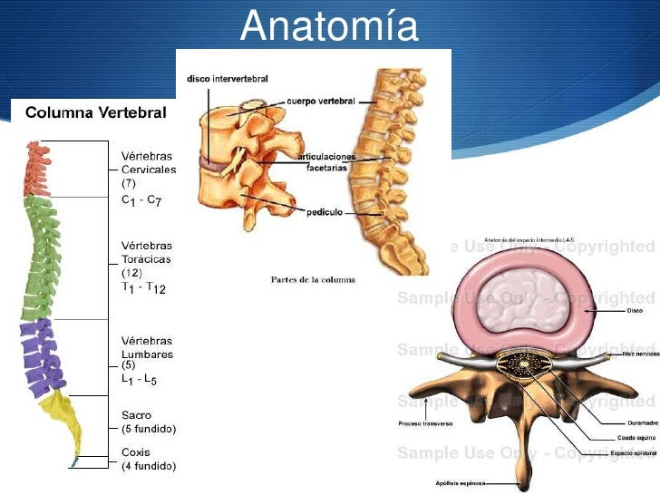 Sindrome de compresion radicular