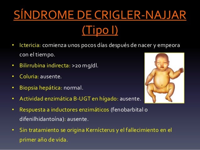 Síndrome de Crigler-Najjar