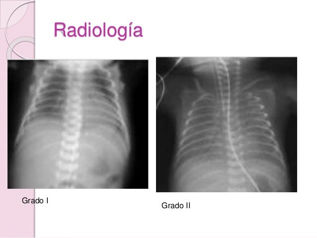 Sindrome de dificultad respiratoria/Sindrome de membrana hialina