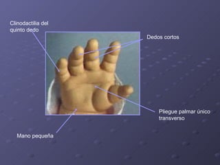 Sindrome de down | PPT