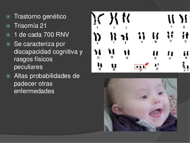 SINDROME DE DOWN / TRISOMIA 21