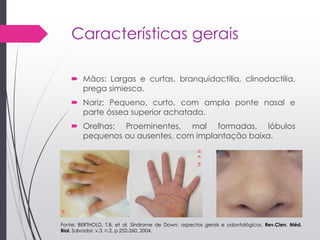 Síndrome de Down | PPTX