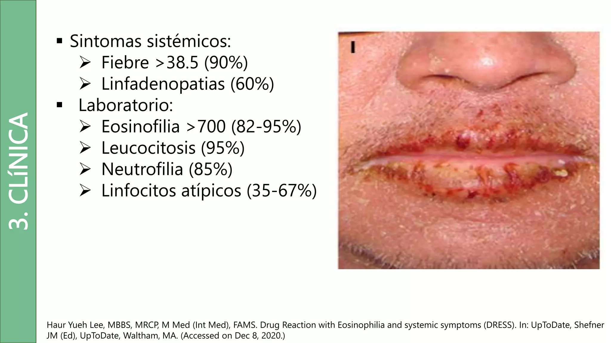 Sindrome de Dress.pptx