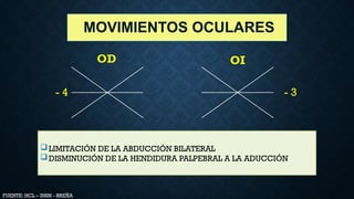 SINDROME DE DUANE BILATERAL CASO CLINICAO | PPTX