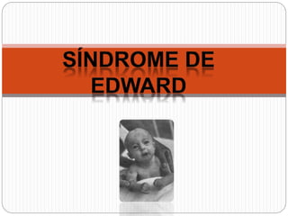 Sindrome de edward | PPTX