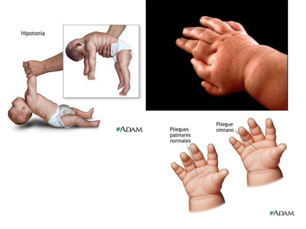 Sindrome de edwards y sindrome de patau