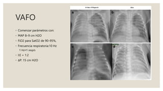 SINDROME DE FUGA AEREA NEONATO R3 KAROL RODRIGUEZ.pptx