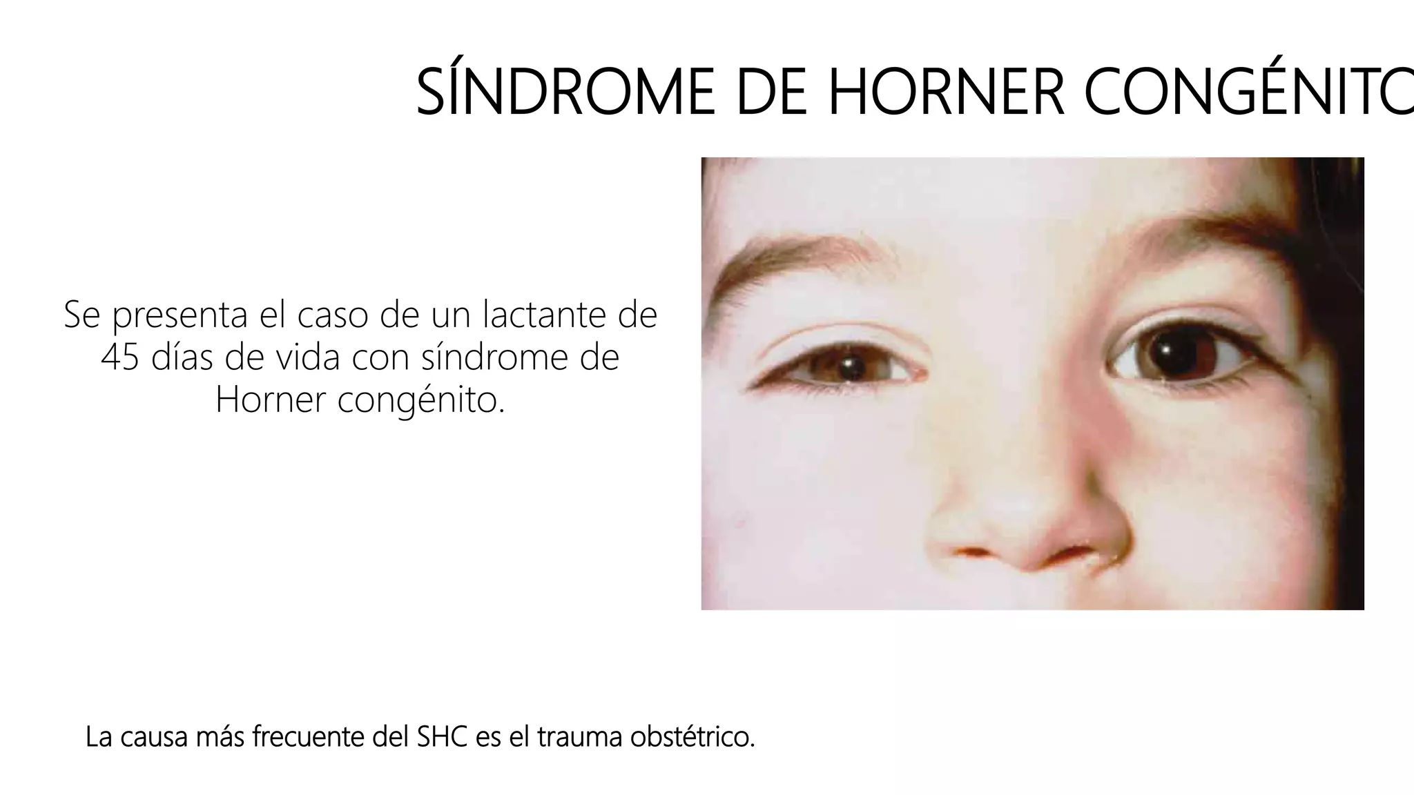 Sindrome de horner congenito | PPTX