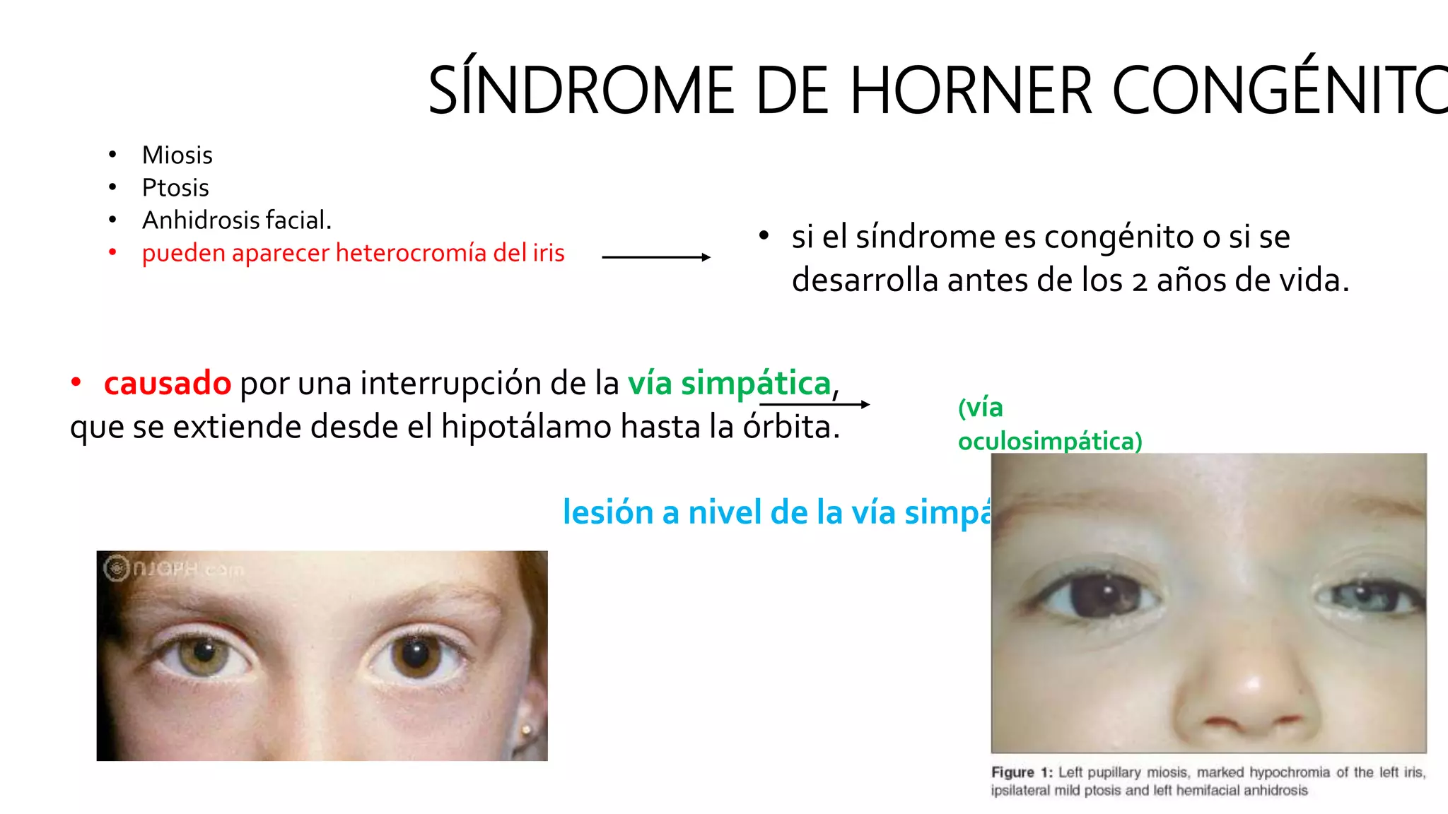 Sindrome de horner congenito | PPTX
