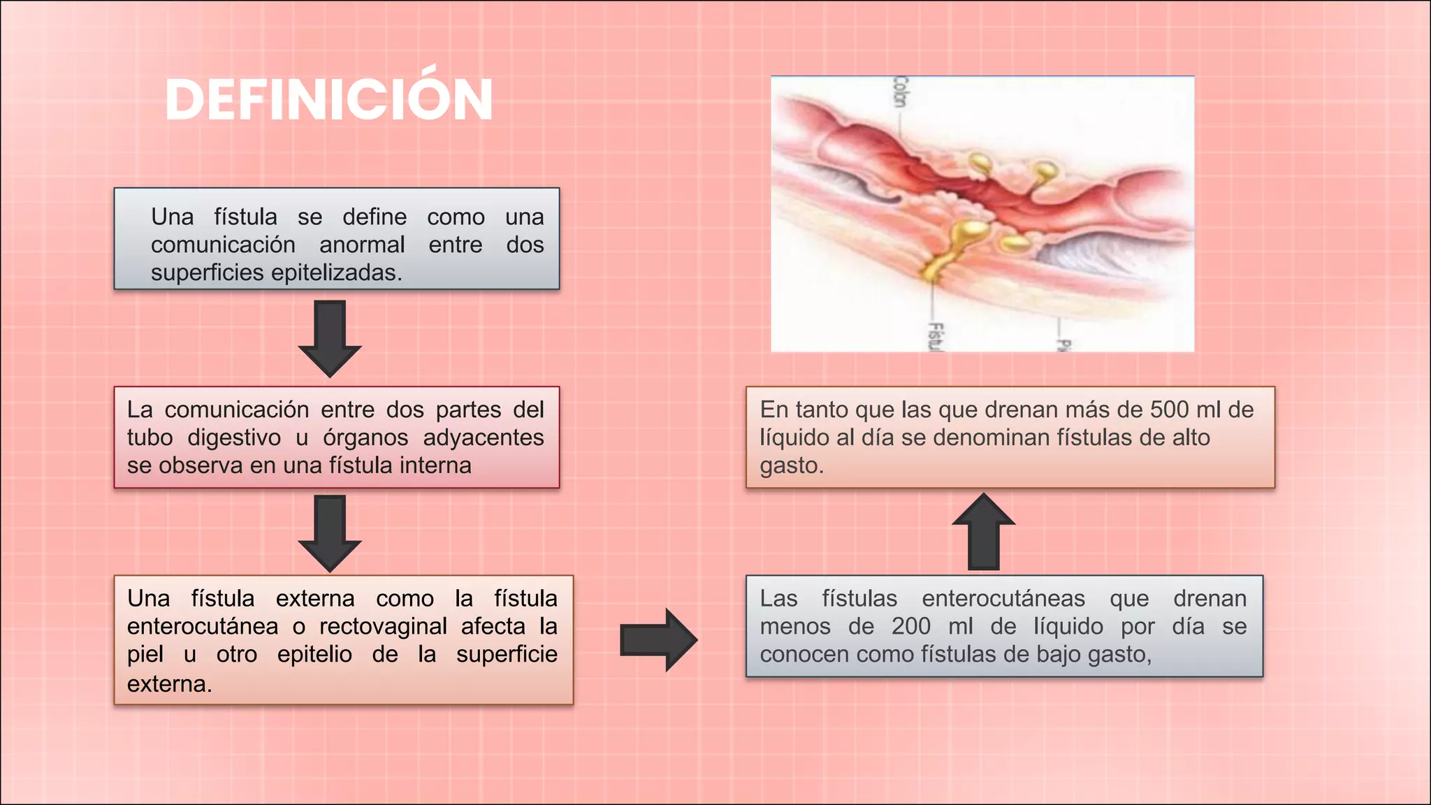SÍNDROME DE INTESTINO CORTO, ESTOMAS, FÍSTULAS INTESTINALES.pdf
