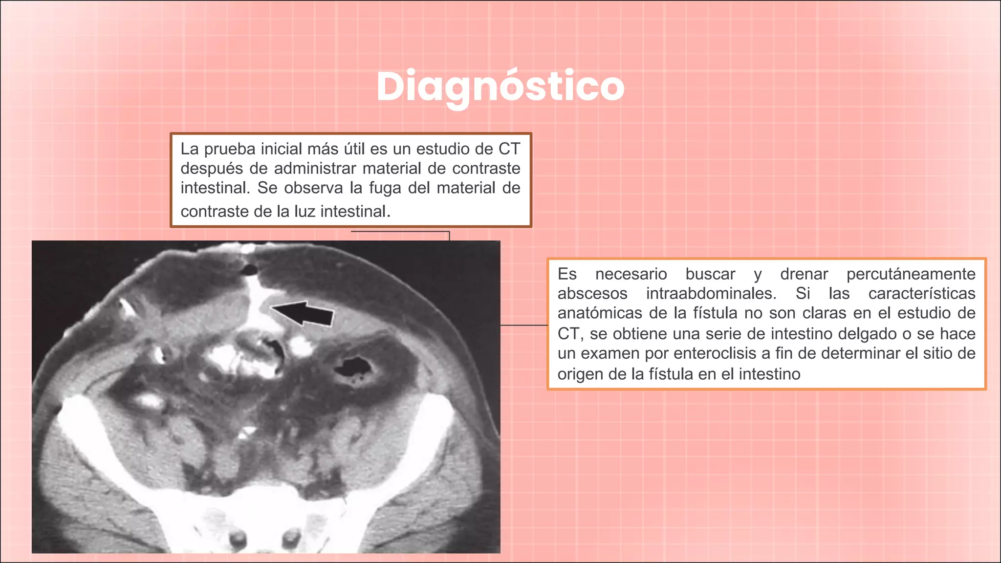 SÍNDROME DE INTESTINO CORTO, ESTOMAS, FÍSTULAS INTESTINALES.pdf