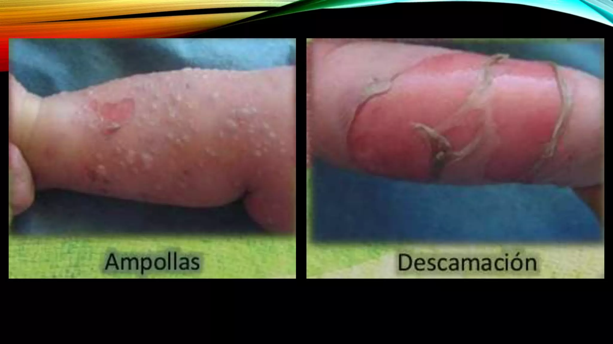 Sindrome de la piel escaldada por estafilococo | PPTX