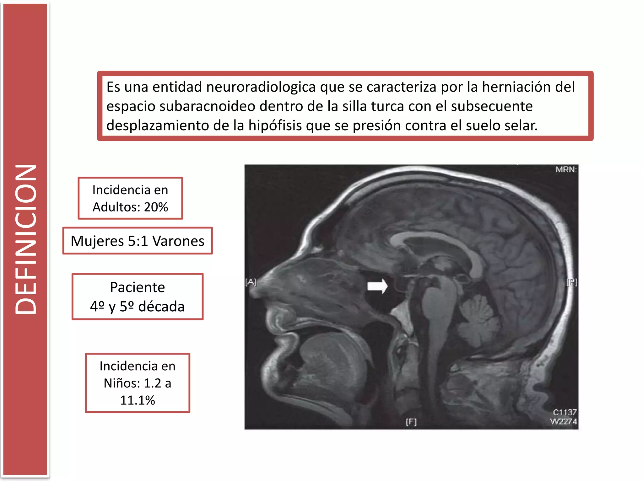 Sindrome de la silla turca vacia | PPTX