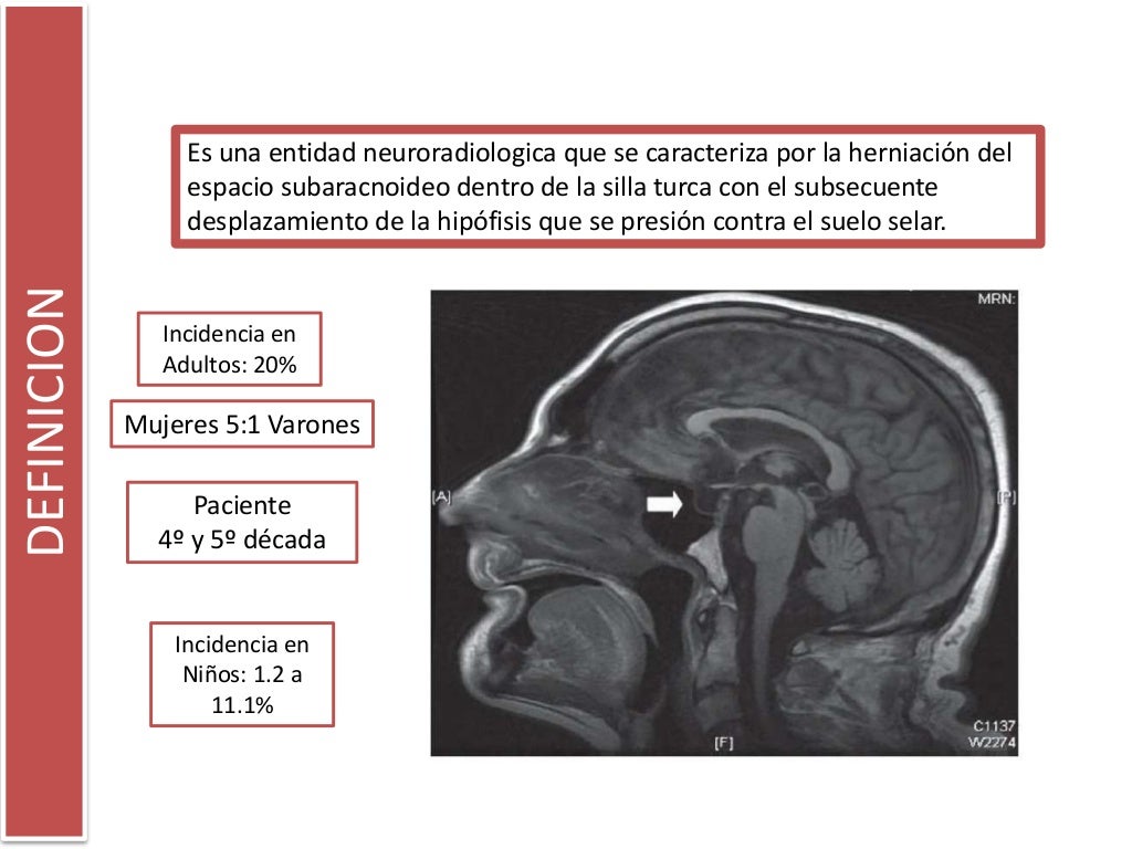 Sindrome de la silla turca vacia