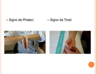 Sindrome del Desfiladero Cervicotorácico | PPTX