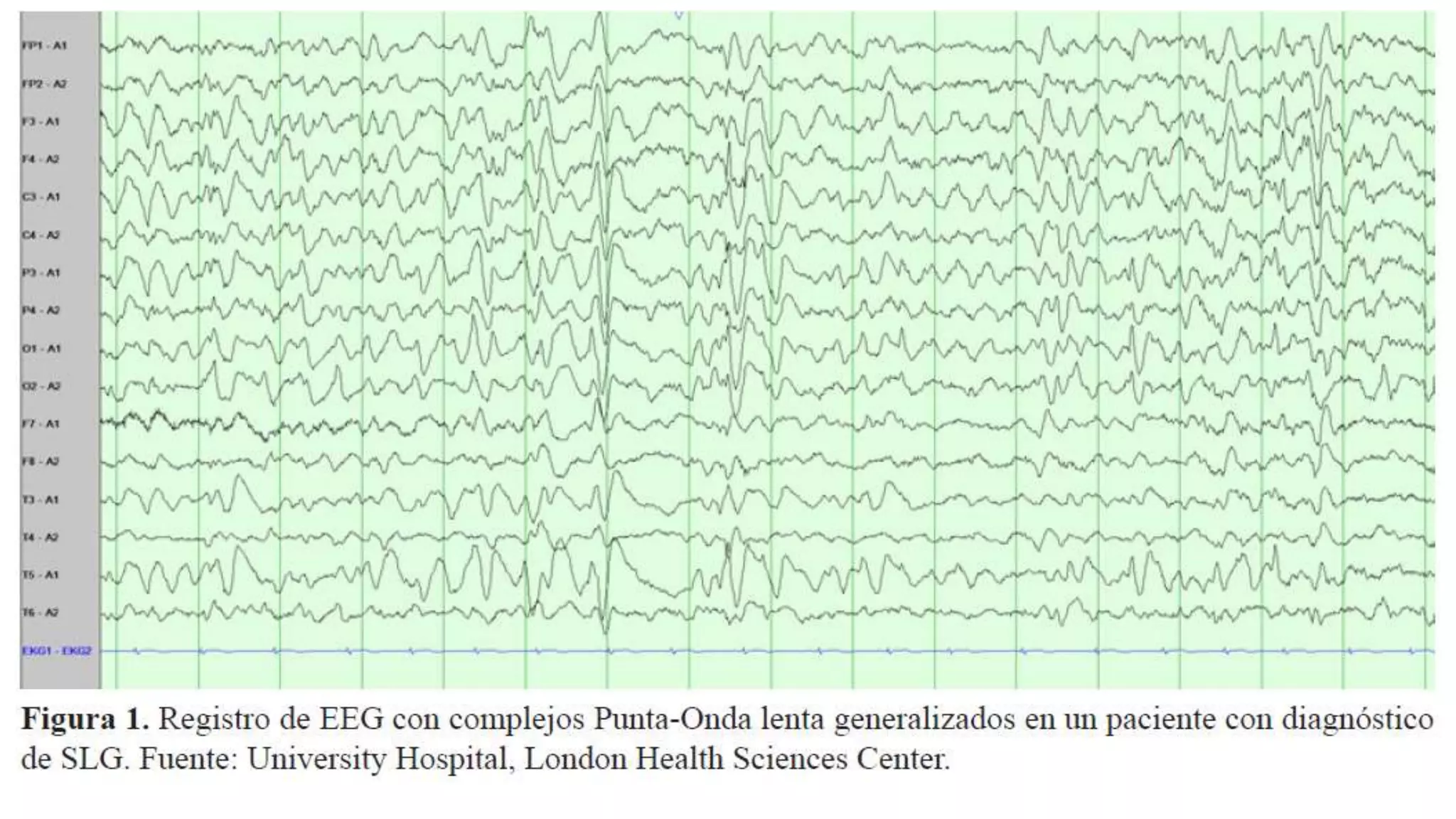Sindrome de lennox gastaut completo | PPT