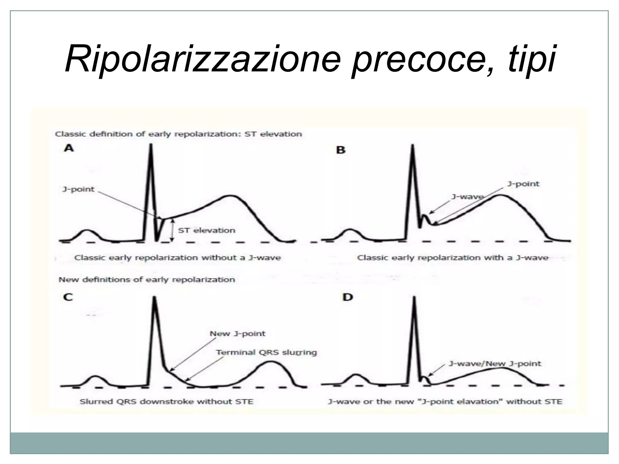 Sindrome della ripolarizzazione precoce | PPT
