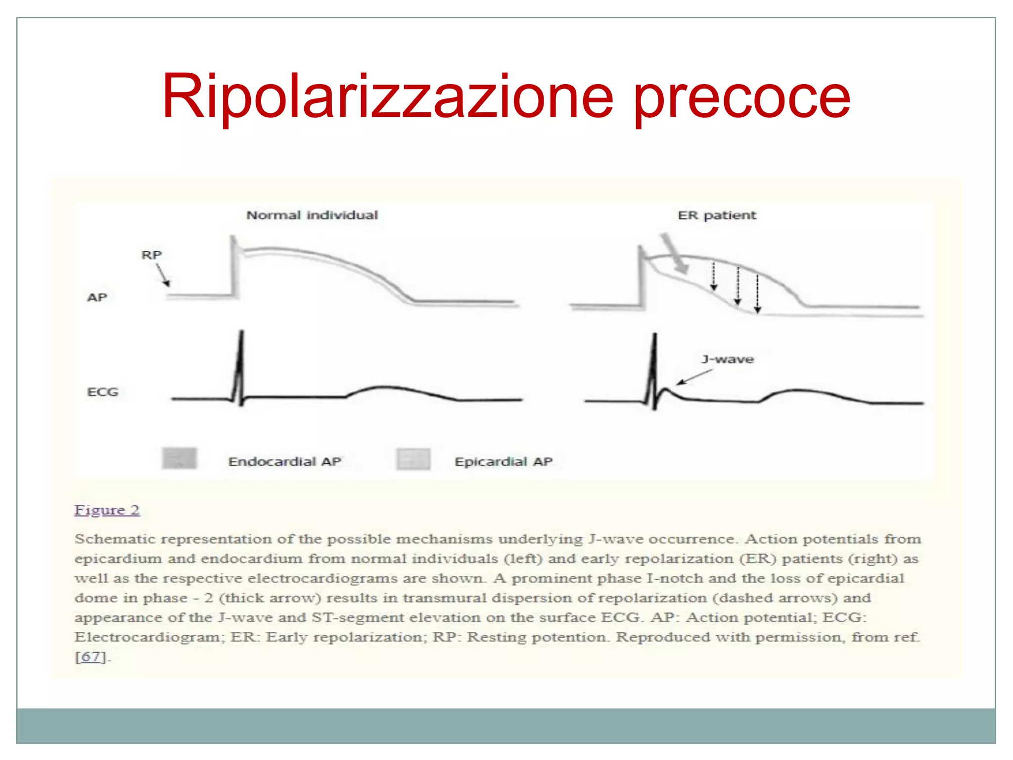 Sindrome della ripolarizzazione precoce | PDF