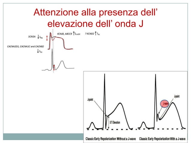 Sindrome della ripolarizzazione precoce | PDF | Heart and ...