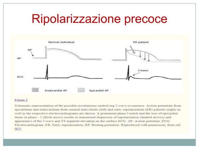 Sindrome della ripolarizzazione precoce | PDF | Heart and ...