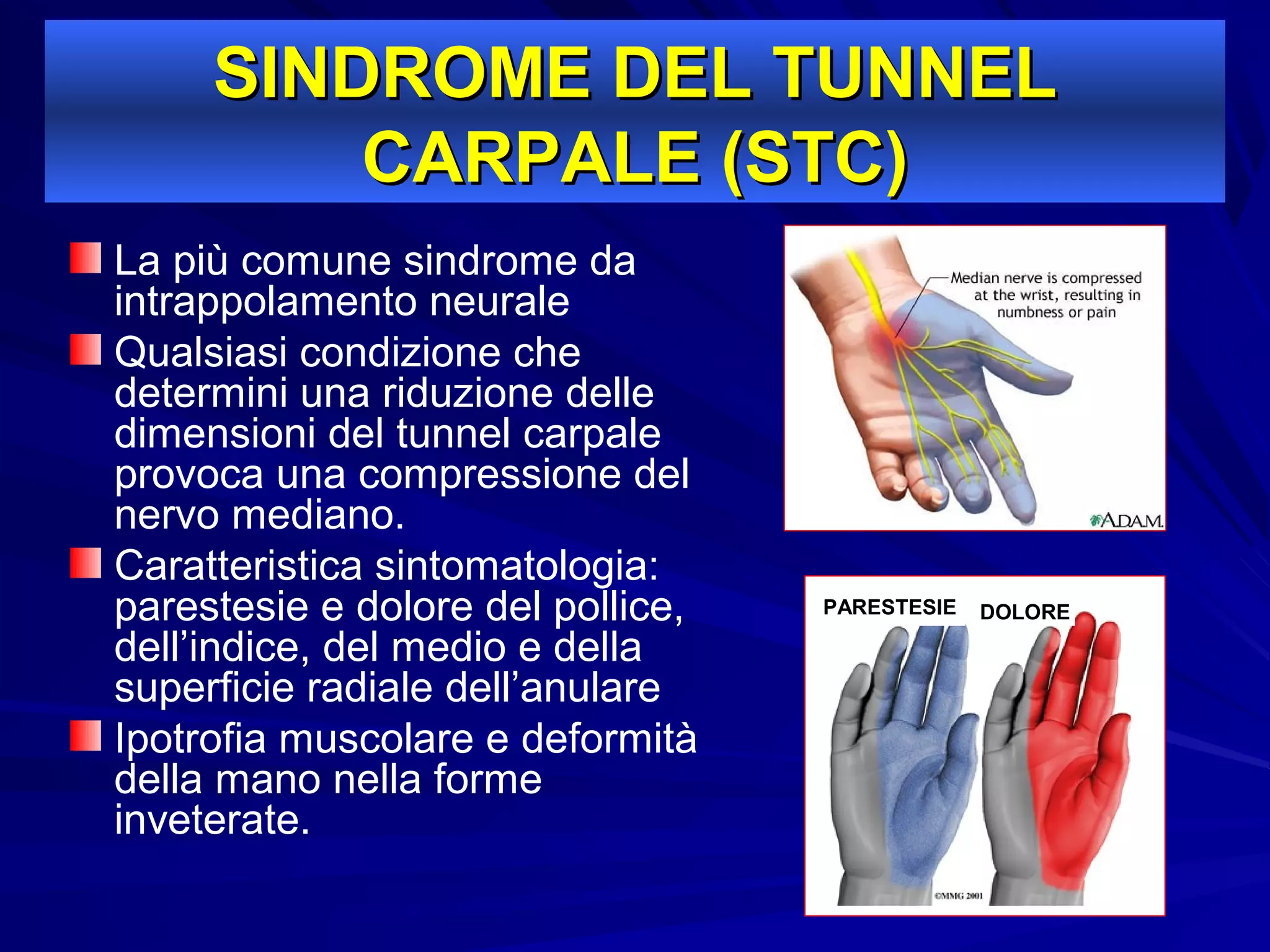 Sindrome del tunnel carpale - Diagnostica per Immagini | PPT